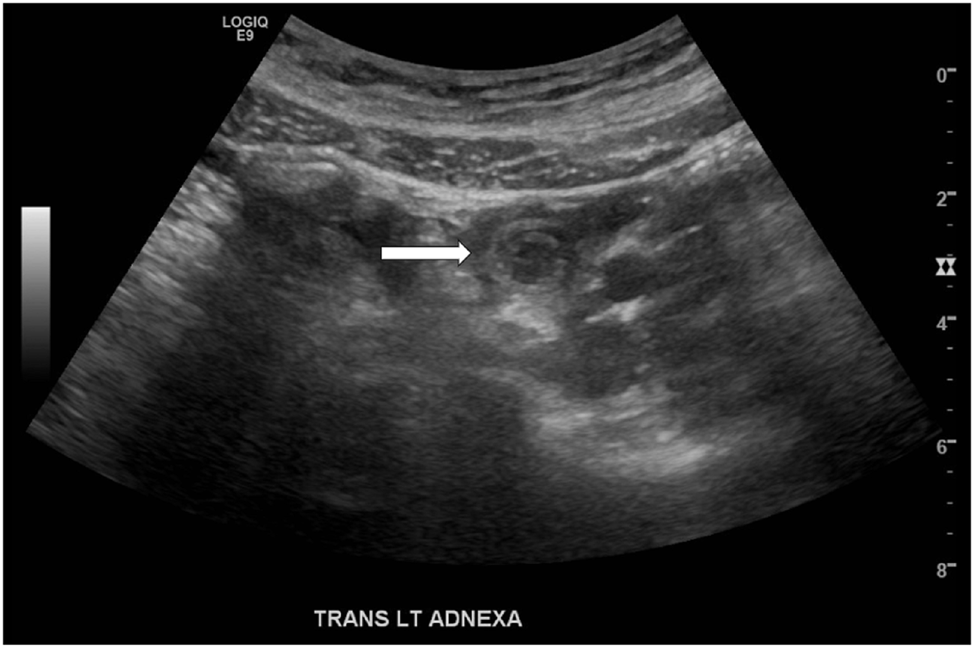 Ultrasound Intussusception