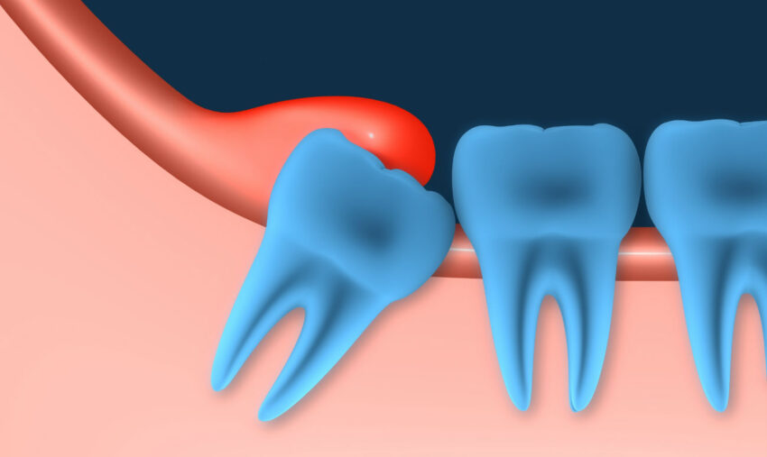 Pericoronitis Treatment At Home