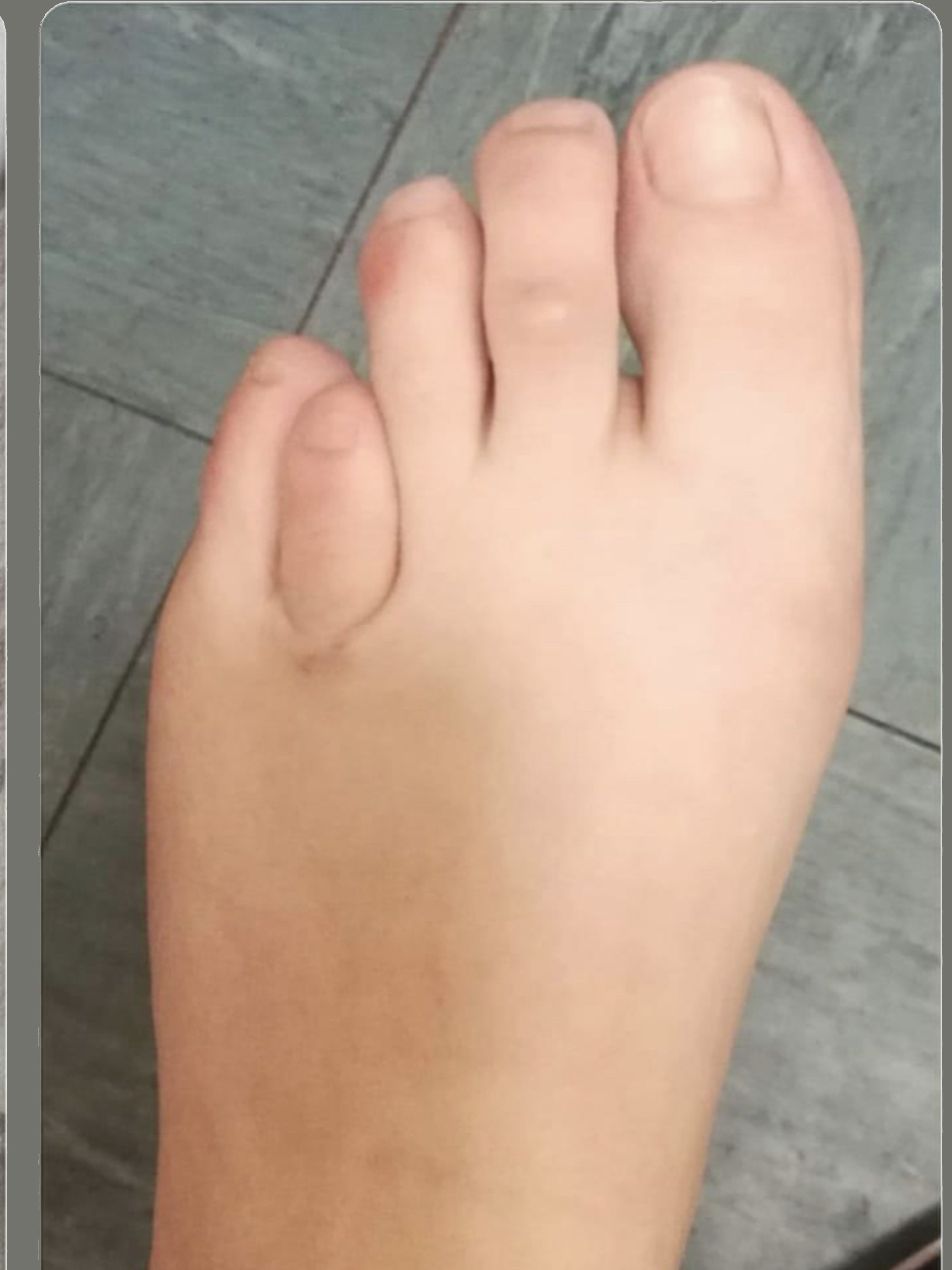 Brachymetatarsia Surgery