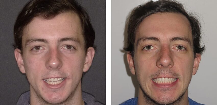 Jaw Surgery Overbite