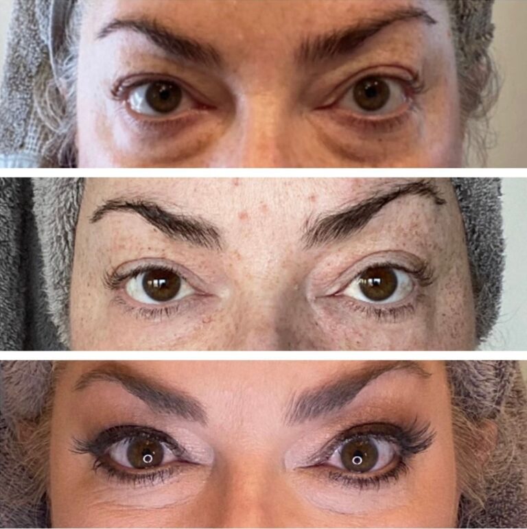 Dermavel Plasma Pen Reviews