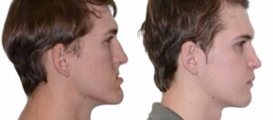 Jaw Surgery Overbite