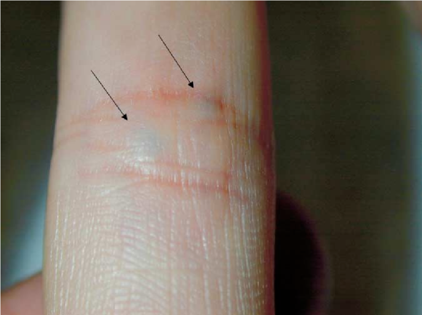 Palmar Digital Vein Thrombosis