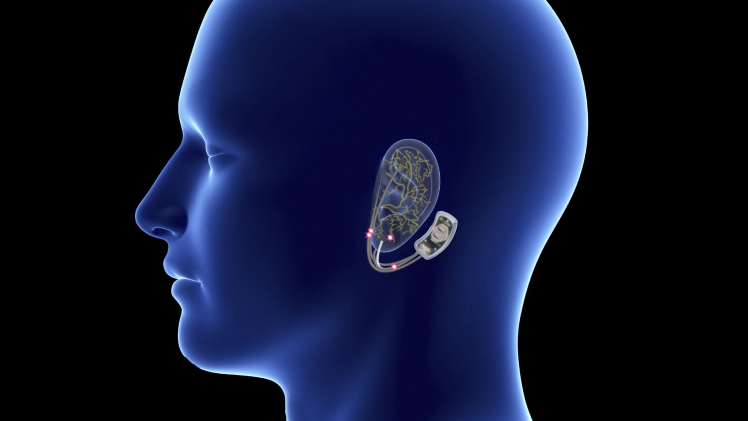 Behind The Ear Wearable Device For Opioid Treatment