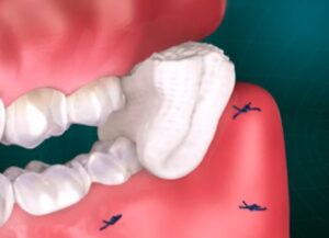 When to Stop Using Gauze After Wisdom Tooth Extraction