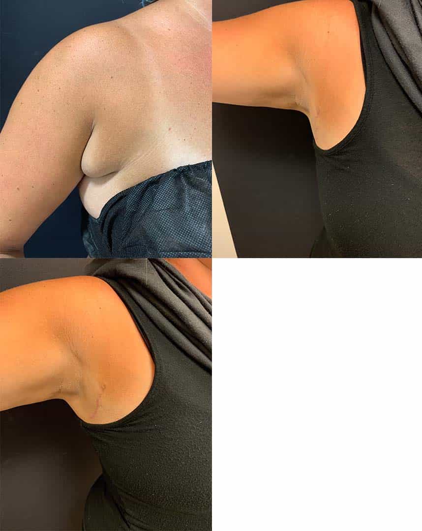 Arm Fat Removal Arm Fat Removal