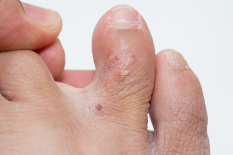 Dyshidrotic Eczema Treatment