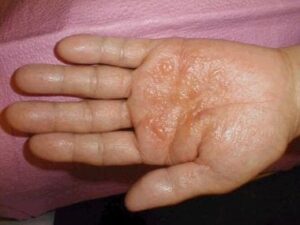 Dyshidrotic Eczema Treatment