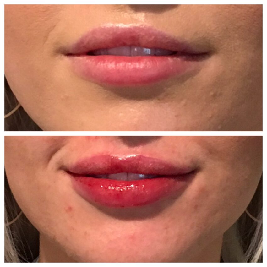 Lip Filler Bruising