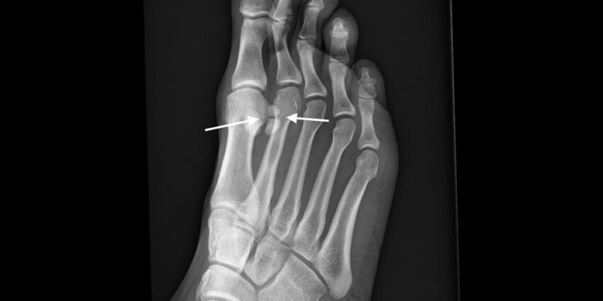 What is the sesamoid bone in the foot?