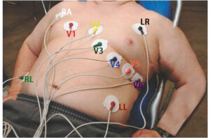 12 lead ecg placement mnemonic
