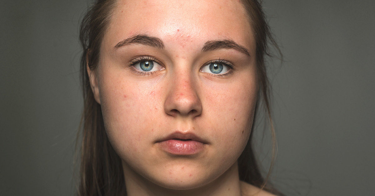 Does Alcohol Cause Acne