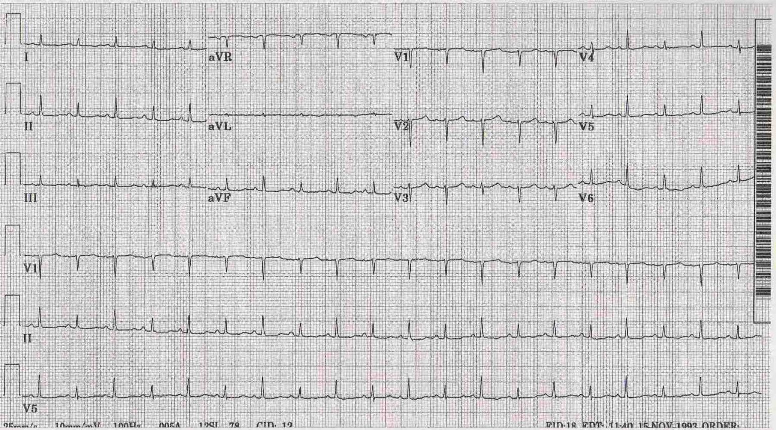 ecg cardiac tamponade