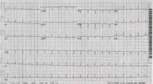 ecg cardiac tamponade