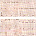 What is a tombstone on ECG?