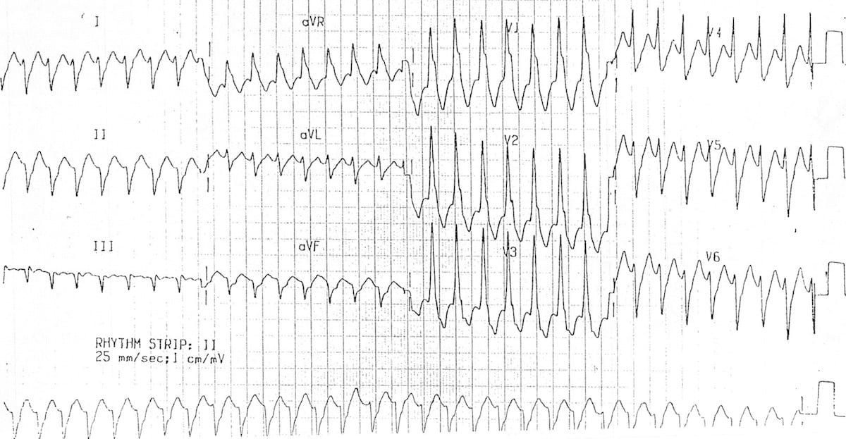 sine wave ecg