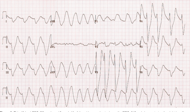 sine wave ecg