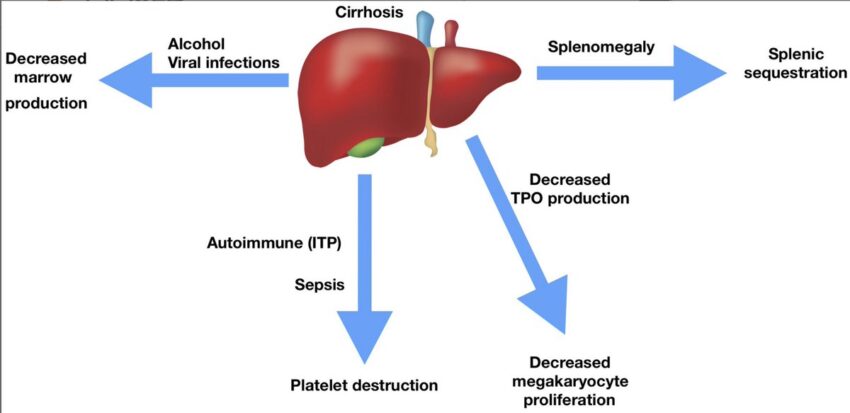 Alcohol Anemia