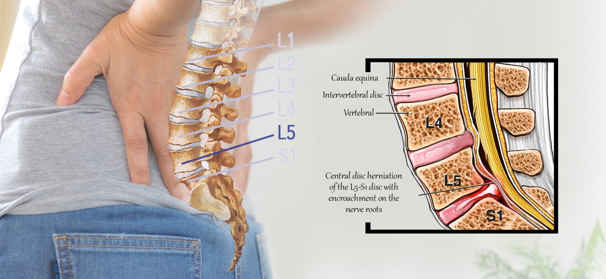 Can Herniated Disc Surgery Cause Paralysis