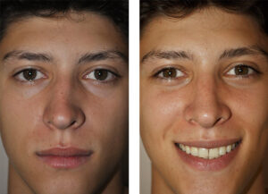 Headaches after sinus surgery