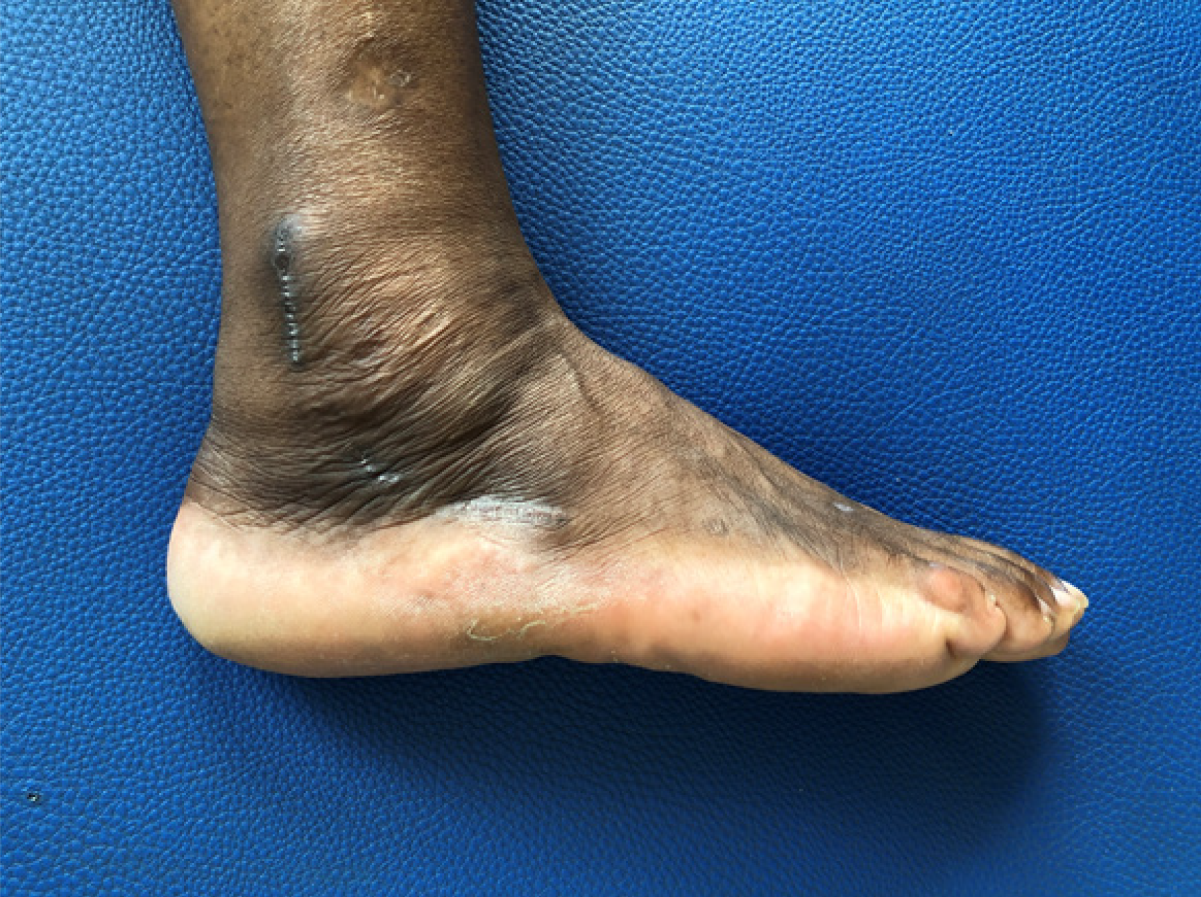 Peroneal tendon surgery