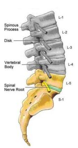 Leg Paralysis After Back Surgery