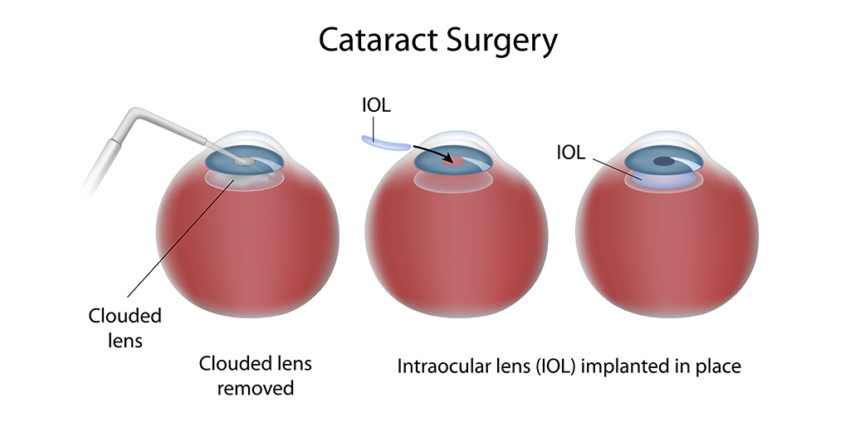 Success Rate Of Cataract Surgery