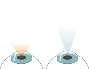 Monovision Cataract Surgery