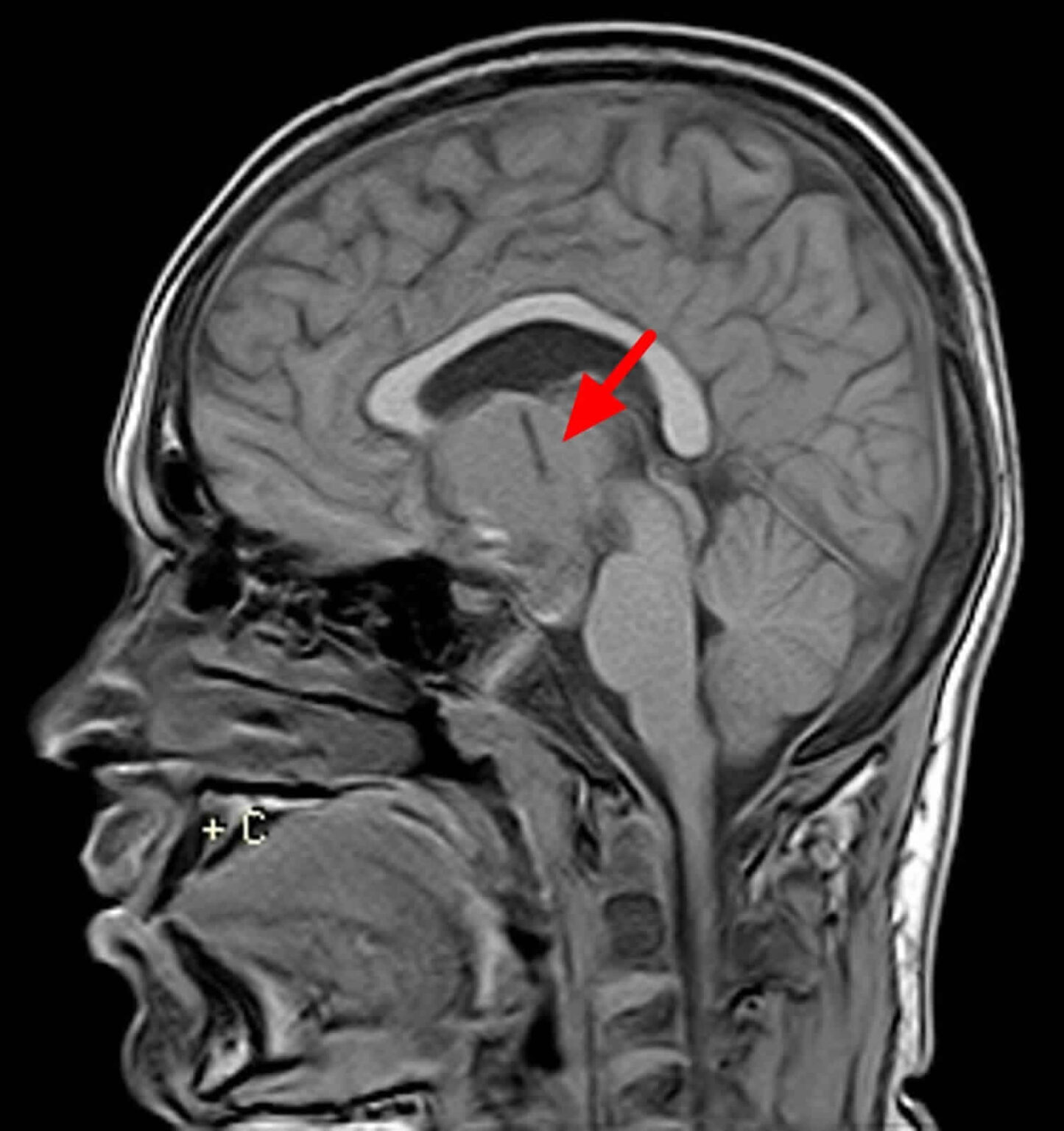 Sublabial Transsphenoidal Pituitary Surgery