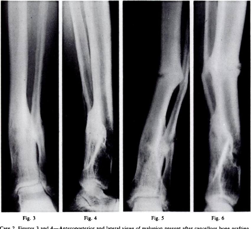 In Osteoclasis A Bone Is