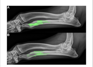 Osteoclasis Medical Term